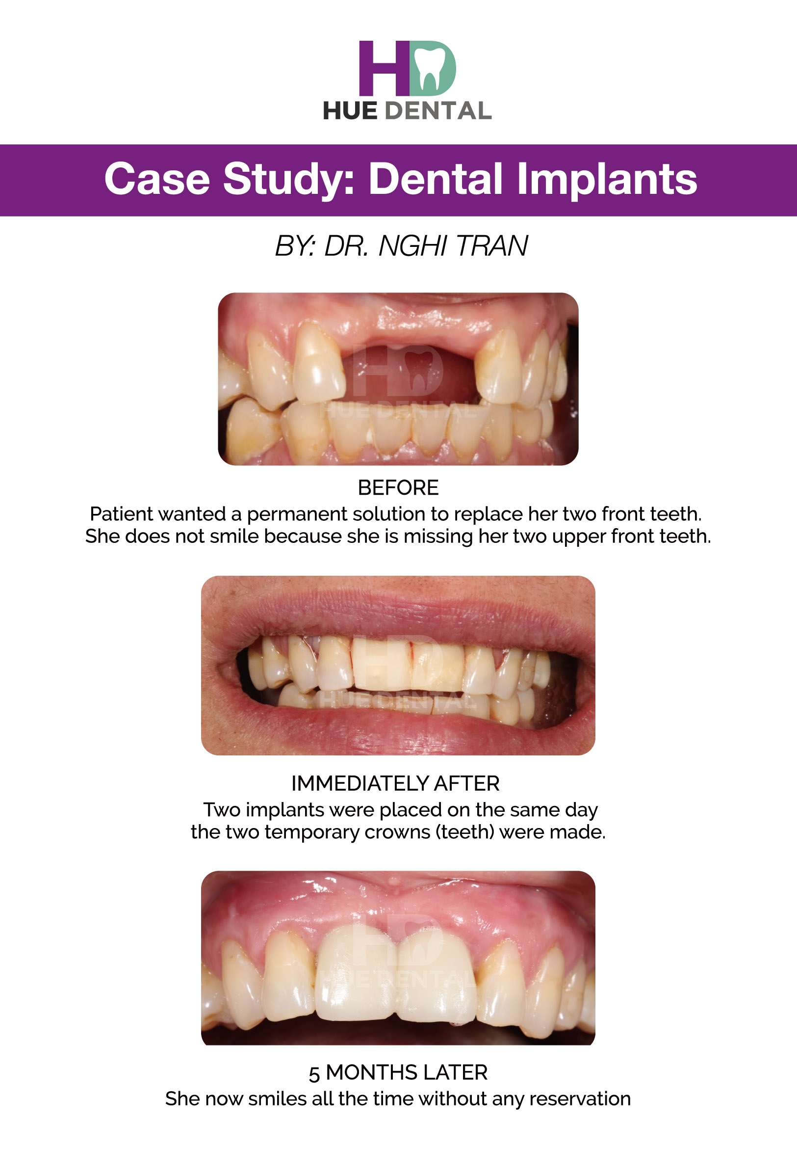 Dental Implants Case Study | Hue Dental