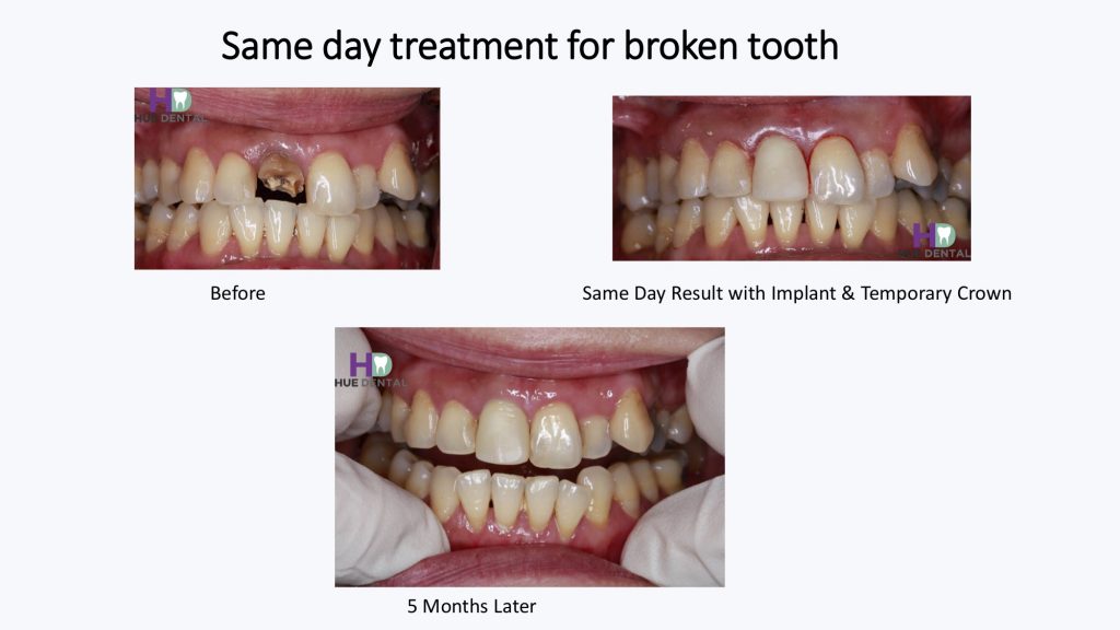 Dental Implants Case Study | Hue Dental